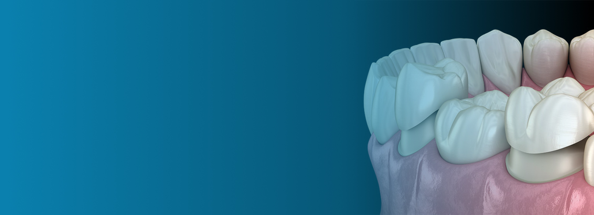 Dental Crown in Dubai | Zirconia Crown in Dubai