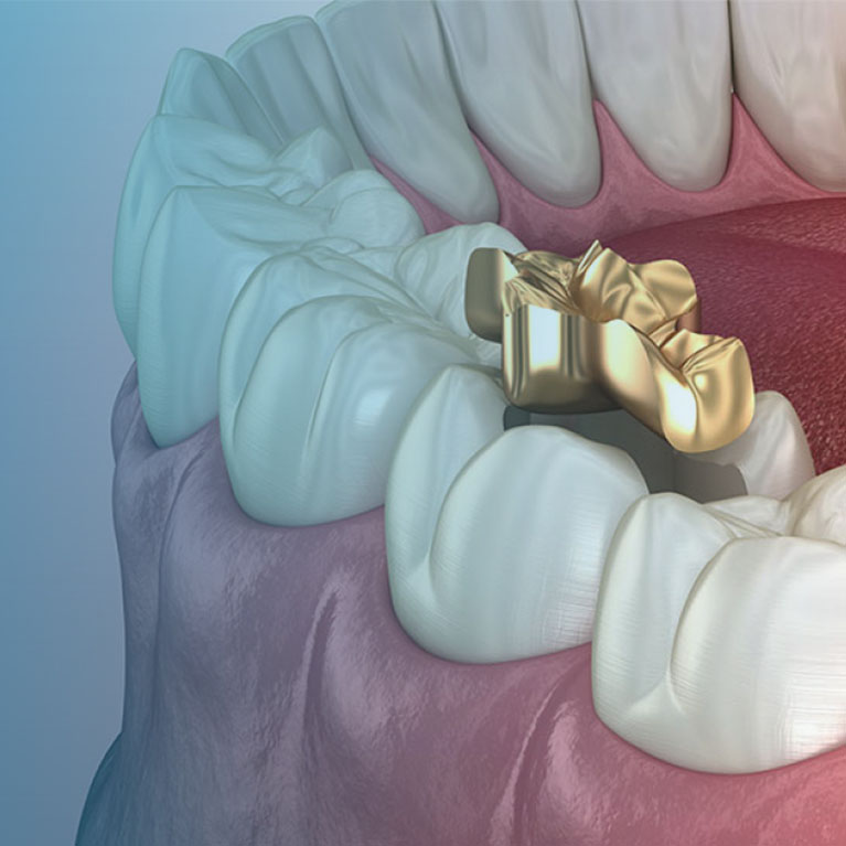 Onlay in Dubai | Porcelain Filling in Dubai | Inlay in Dubai