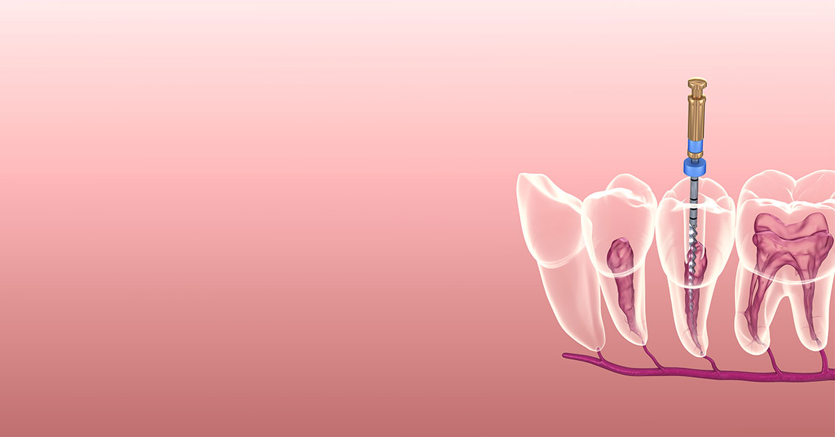 Root Canal Treatments - Oris Dental Center